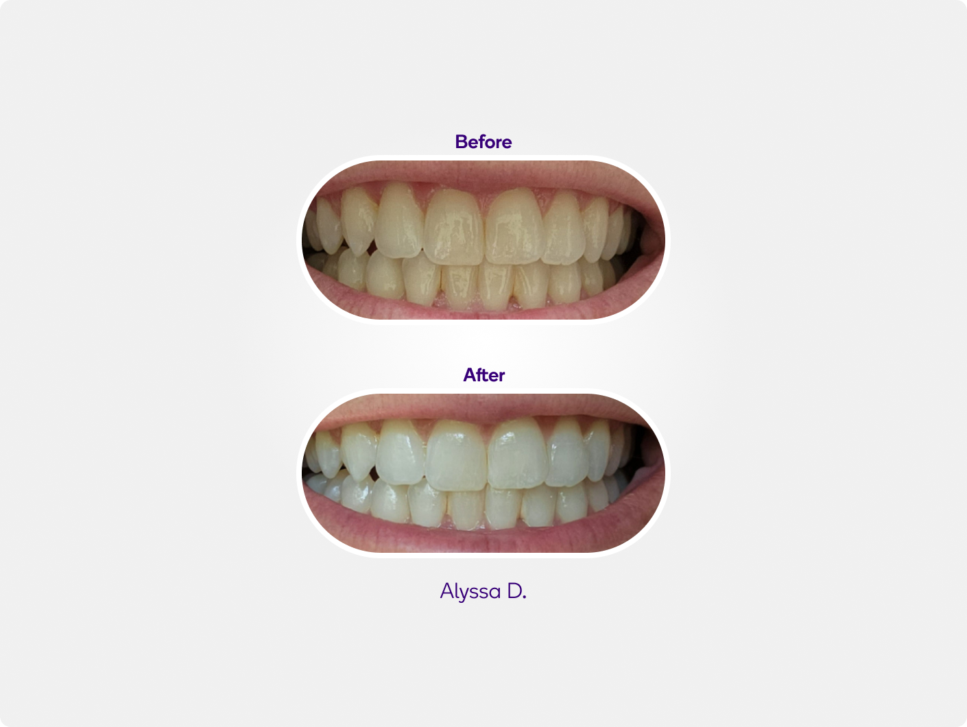 Precision Whitening Pen | BURST Oral Care